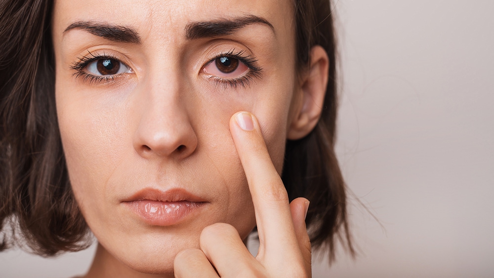 How Do I Get Rid Of A Chalazion